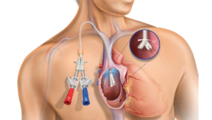 Expert Permacath Insertion for Dialysis in Pune