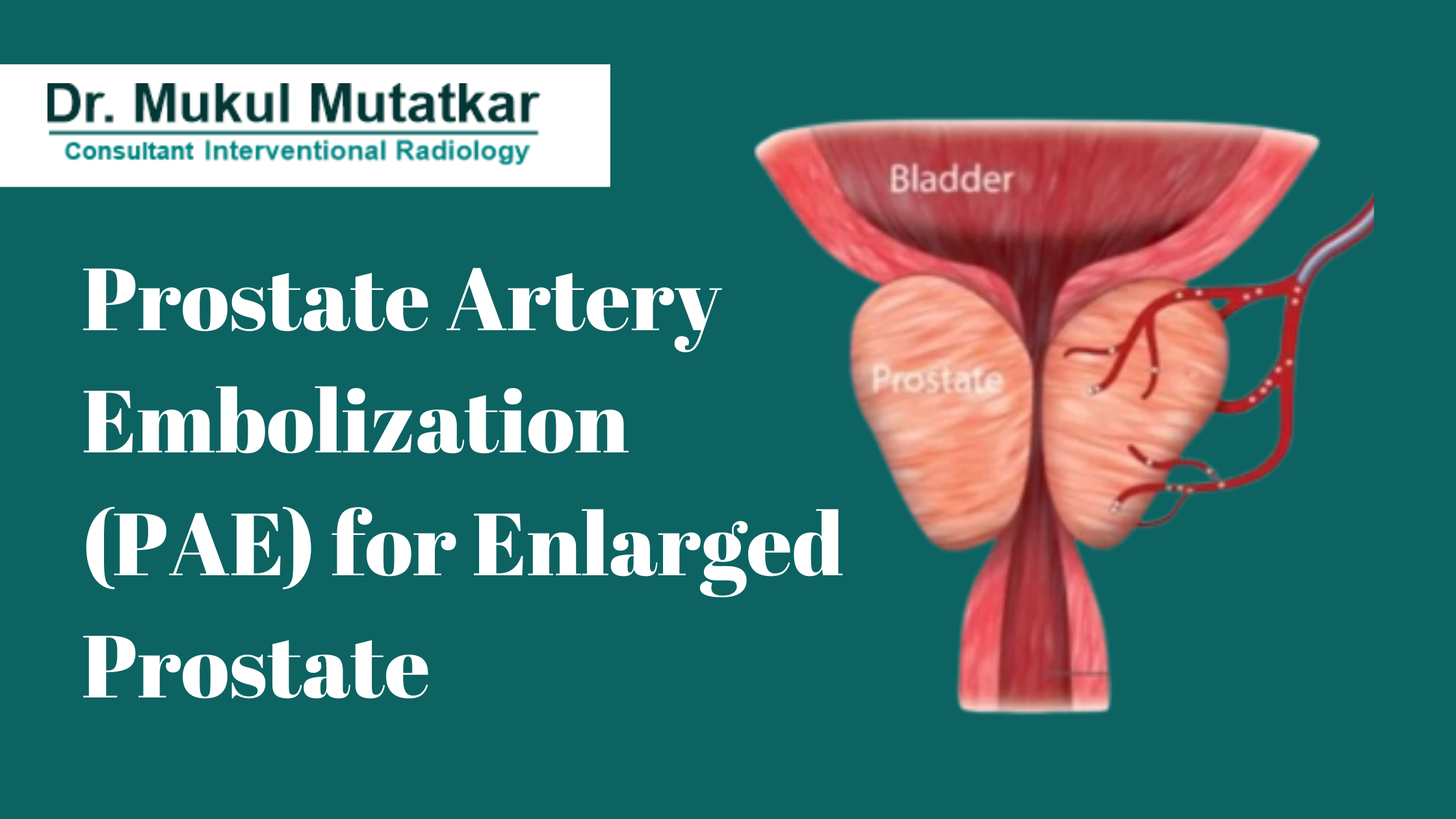 Prostate Artery Embolization (PAE) for Enlarged Prostate: A ...